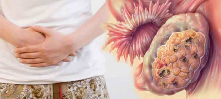 Kanser ovari – Dr R Juhaidah Blog