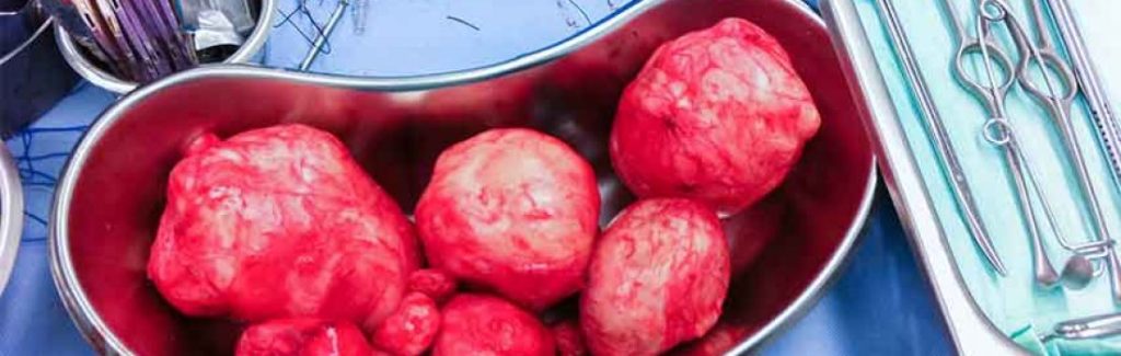 Anda Ada Fibroid tetapi Anda Tidak Perlukan Pembedahan Jika… – Dr R ...